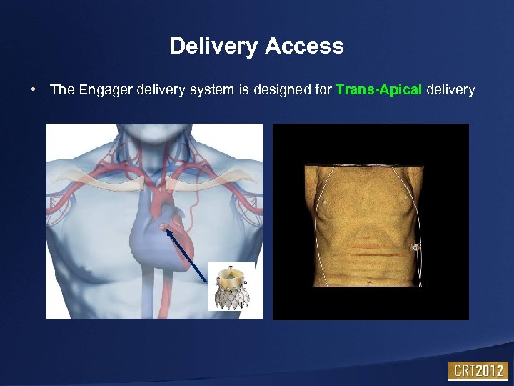 The Medtronic Ventor Engager TM TAVI System Hendrik