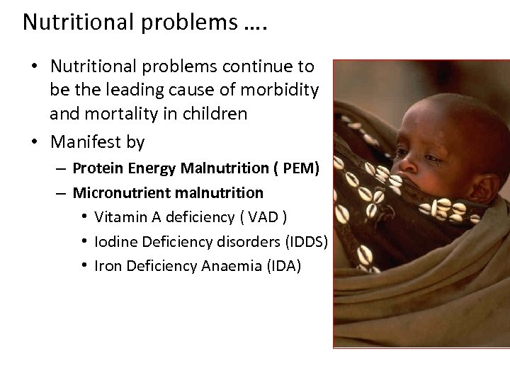 Nutritional problems of children in Ethiopia Mekitie Wondafrash MD