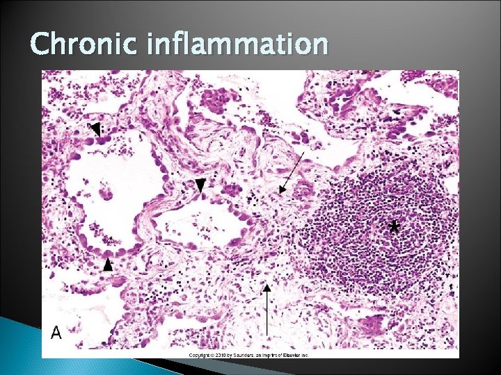 CHRONIC INFLAMMATION CHRONIC INFLAMMATION Prolonged inflammatory