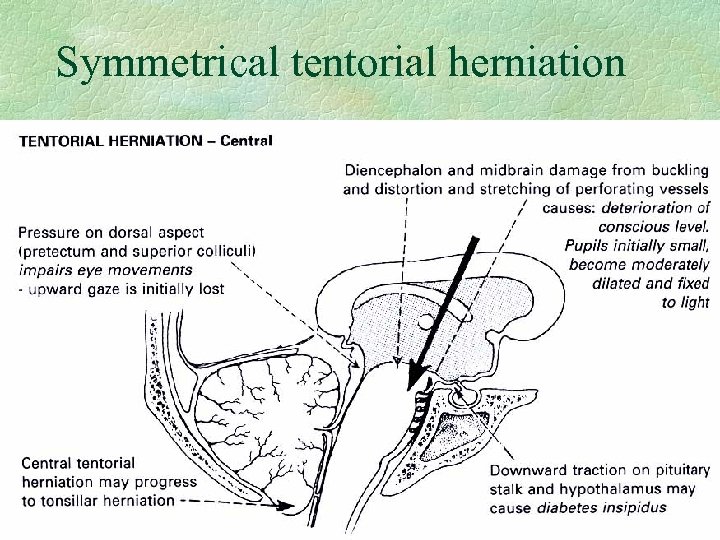 Disturbances of Intra-Cranial Pressure ICP and Hydrocephalus Andrew