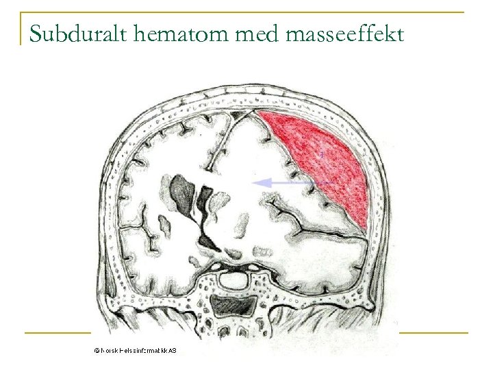 Kronisk subduralt hematom — kasuistikker Fjernundervisning i geriatri