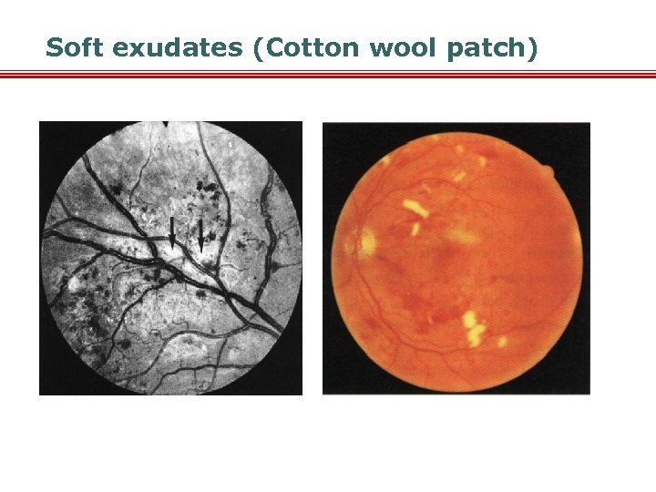 당뇨합병증 검사의 이해 내분비대사내과 -2
