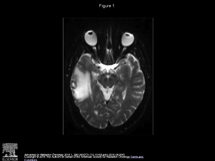 Cryptic Nocardia nova brain abscess postradiation treatment and