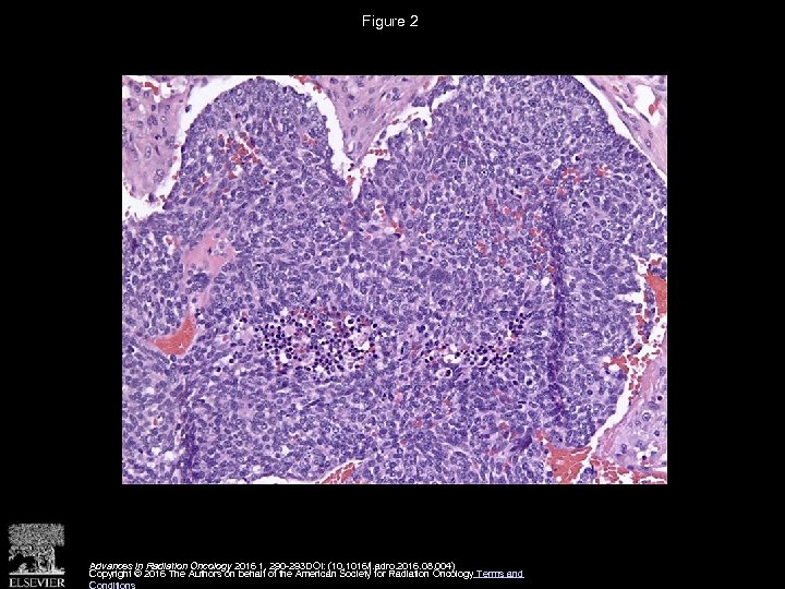 Cryptic Nocardia nova brain abscess postradiation treatment and