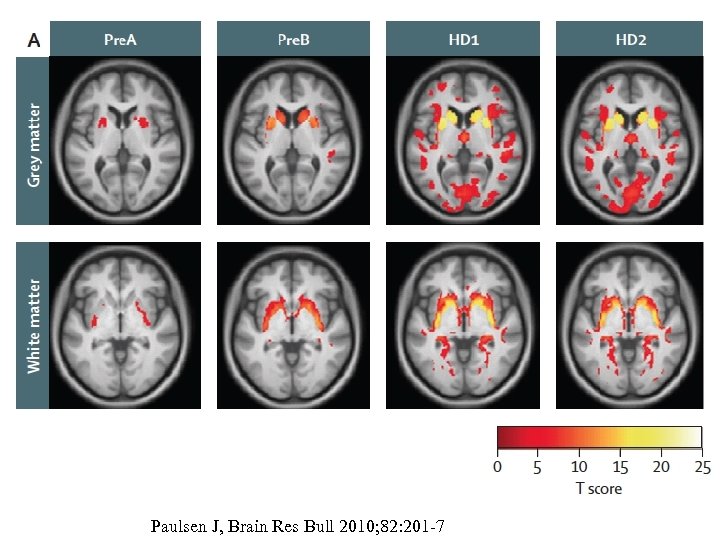 When does Huntington s Disease Begin Richard Dubinsky MD
