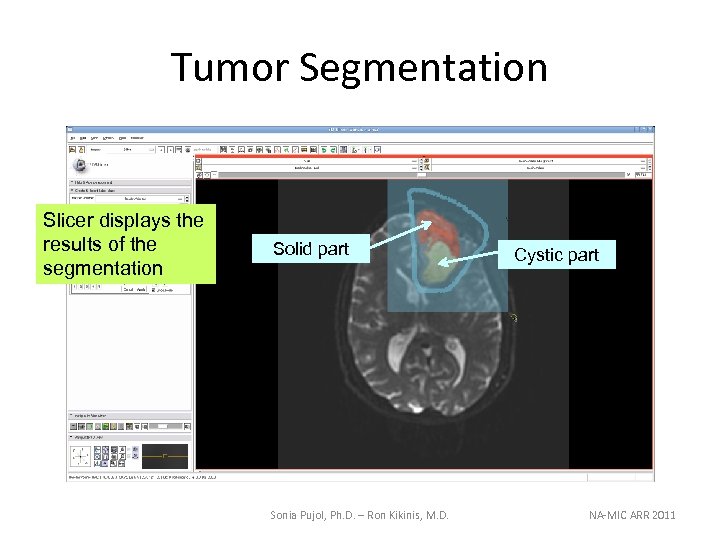 Exploring Peritumoral White Matter Fibers for Neurosurgical Planning