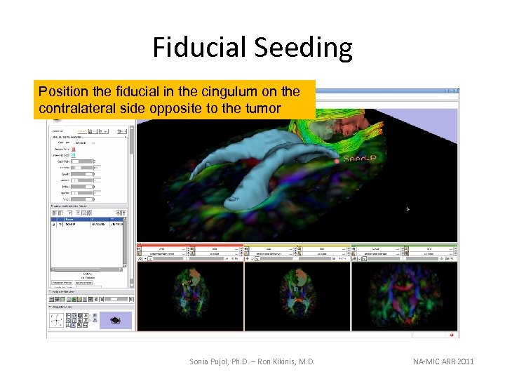 Exploring Peritumoral White Matter Fibers for Neurosurgical Planning
