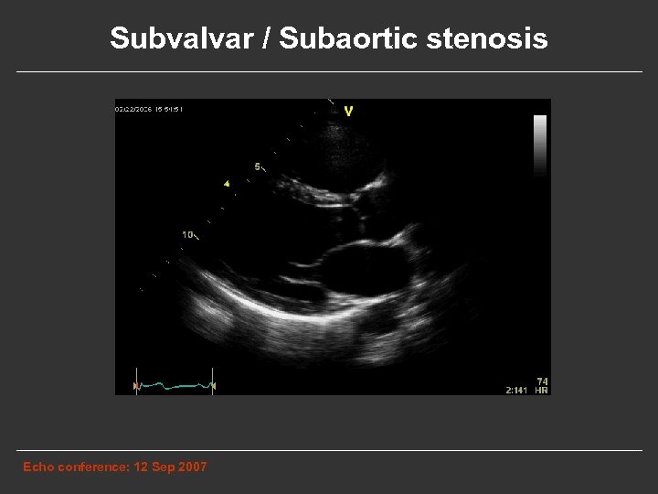 Aortic Stenosis Randall Harada Echo conference 12 Sep