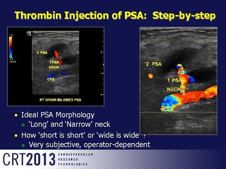 Safety and Efficacy of Ultrasound-Guided Thrombin Injections at