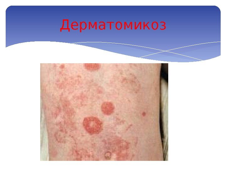 Микоз қоздырғыштар Саңырауқұлақтар тудыратын аурулар микоздар деп аталады.